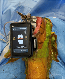 Case Study: Use of Portable, Precision Alignment - OrthAlign