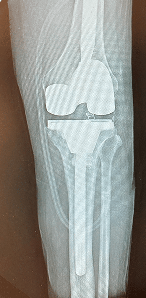 Case Study: Use of Portable, Precision Alignment - OrthAlign