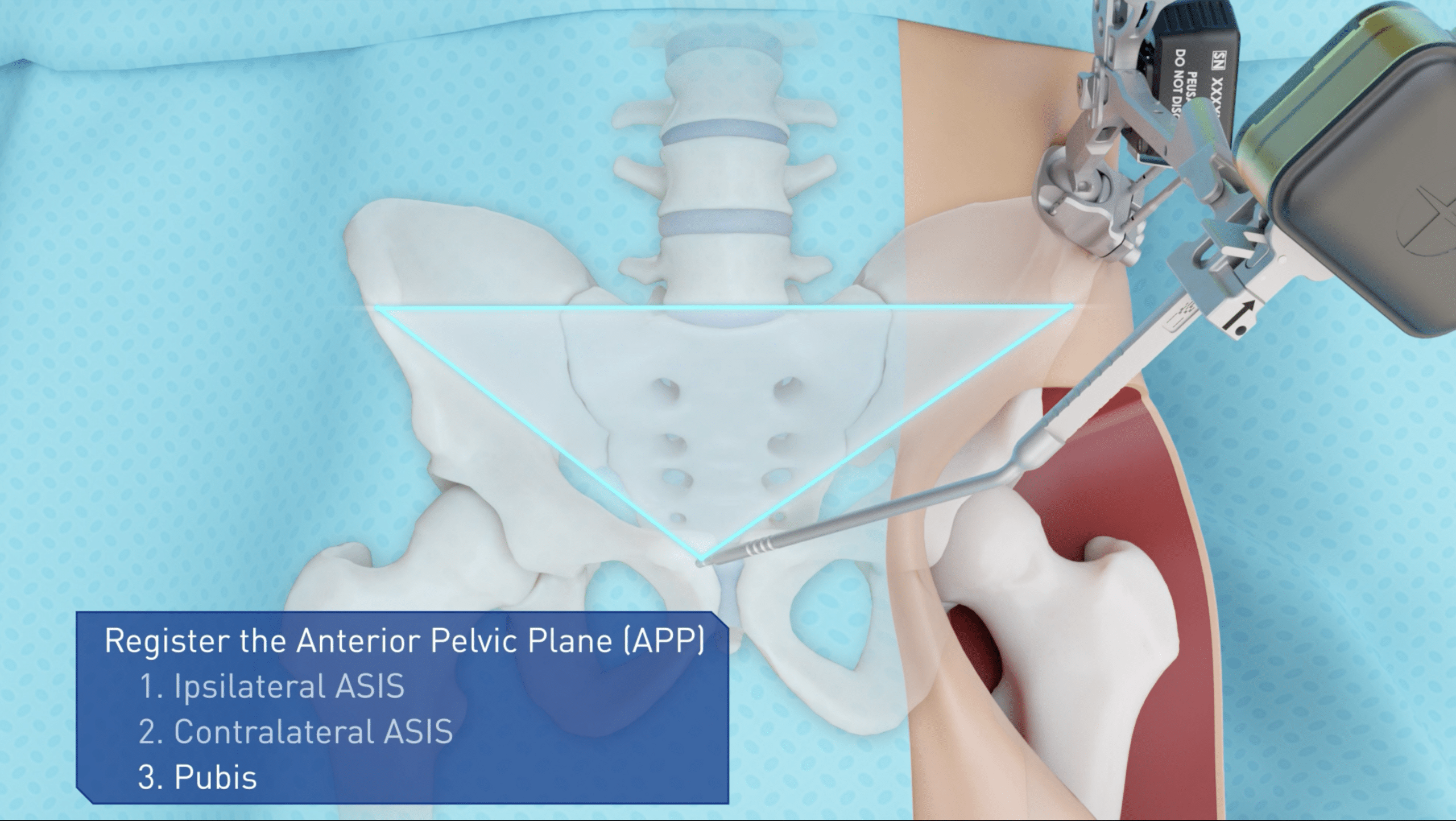 OrthAlign | Lantern Hip Overview
